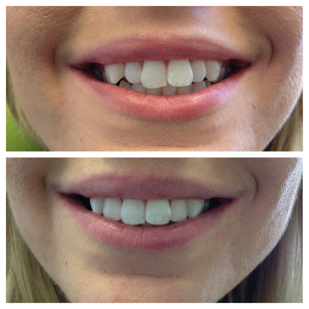Componeers ™ Innovative Veneers in Vaughan
